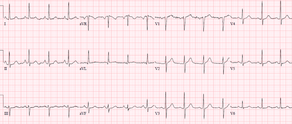 Misdiagnosis from ECG Lead Misplacement, Artifact and Lead Reversal ...