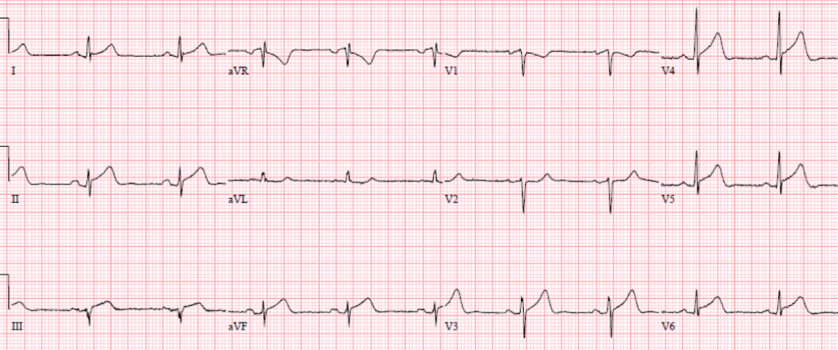 Misdiagnosis from ECG Lead Misplacement, Artifact and Lead Reversal ...