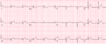 Misdiagnosis from ECG Lead Misplacement, Artifact and Lead Reversal ...