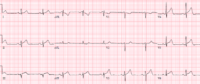 Misdiagnosis from ECG Lead Misplacement, Artifact and Lead Reversal ...