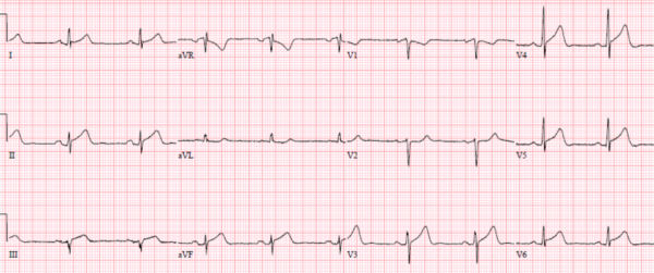 Misdiagnosis from ECG Lead Misplacement, Artifact and Lead Reversal ...