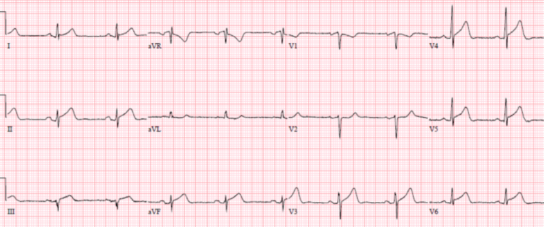 Misdiagnosis from ECG Lead Misplacement, Artifact and Lead Reversal ...