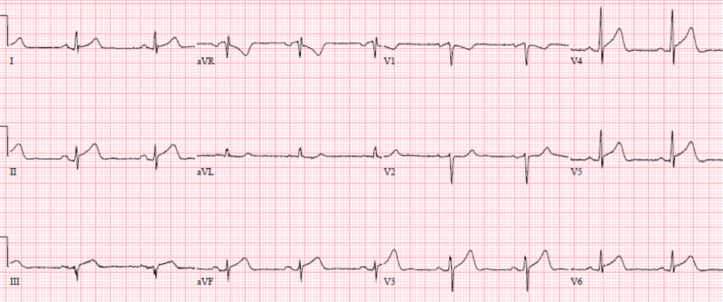 Misdiagnosis from ECG Lead Misplacement, Artifact and Lead Reversal ...