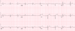 Misdiagnosis from ECG Lead Misplacement, Artifact and Lead Reversal ...