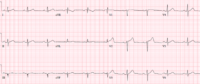 Misdiagnosis from ECG Lead Misplacement, Artifact and Lead Reversal ...