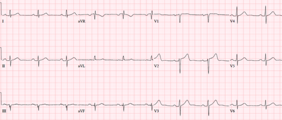 Misdiagnosis from ECG Lead Misplacement, Artifact and Lead Reversal ...