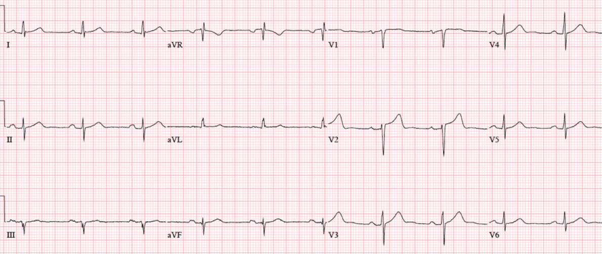 Misdiagnosis from ECG Lead Misplacement, Artifact and Lead Reversal ...