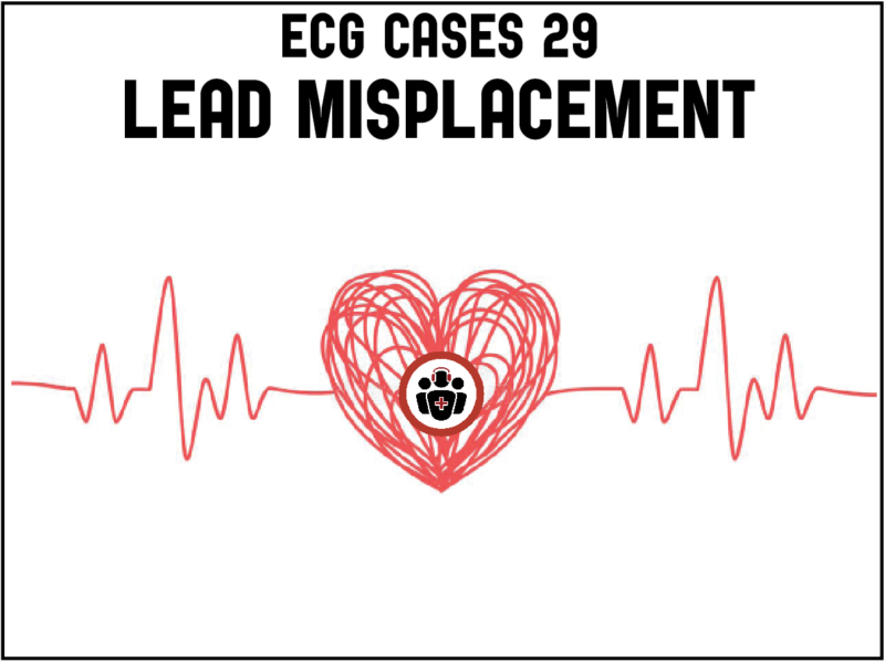 Misdiagnosis from ECG Lead Misplacement, Artifact and Lead Reversal ...