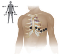 Misdiagnosis from ECG Lead Misplacement, Artifact and Lead Reversal ...