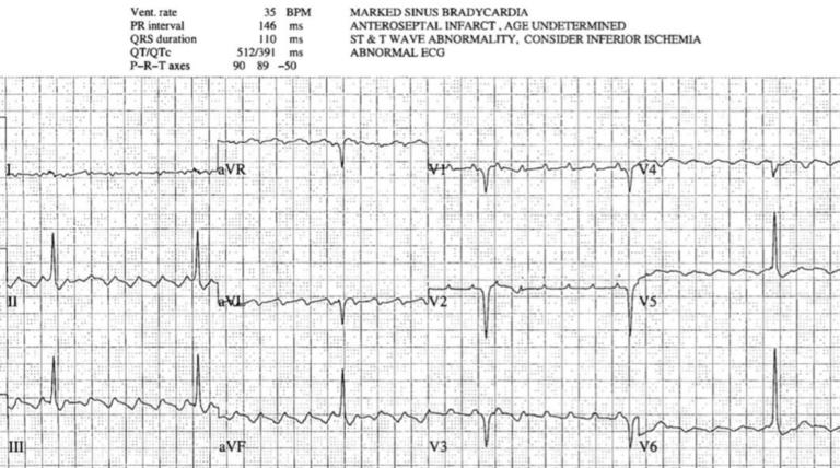 Beware Computer Interpretation Errors | ECG Cases | EM Cases