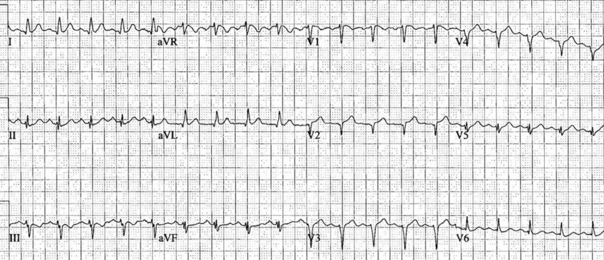 Beware Computer Interpretation Errors | ECG Cases | EM Cases
