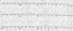 Beware Computer Interpretation Errors | ECG Cases | EM Cases