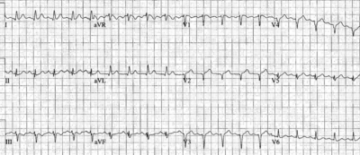 Beware Computer Interpretation Errors | ECG Cases | EM Cases