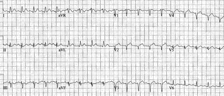 Beware Computer Interpretation Errors | ECG Cases | EM Cases