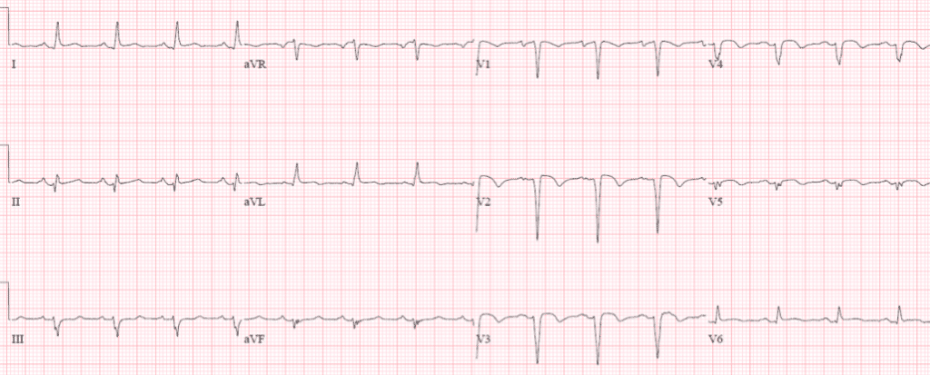 Beware Computer Interpretation Errors | ECG Cases | EM Cases