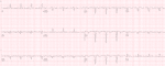 Beware Computer Interpretation Errors | ECG Cases | EM Cases
