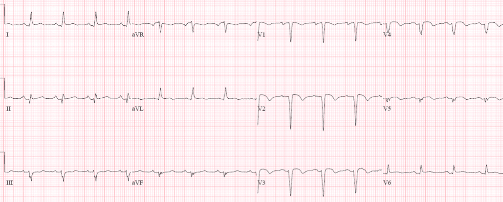 Beware Computer Interpretation Errors | ECG Cases | EM Cases