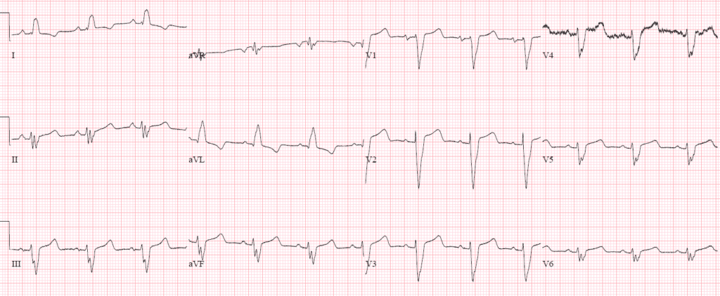 Beware Computer Interpretation Errors | ECG Cases | EM Cases