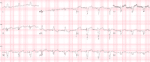 Beware Computer Interpretation Errors | ECG Cases | EM Cases