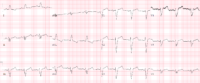 Beware Computer Interpretation Errors | ECG Cases | EM Cases