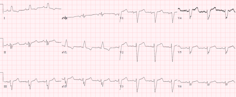 Beware Computer Interpretation Errors | ECG Cases | EM Cases
