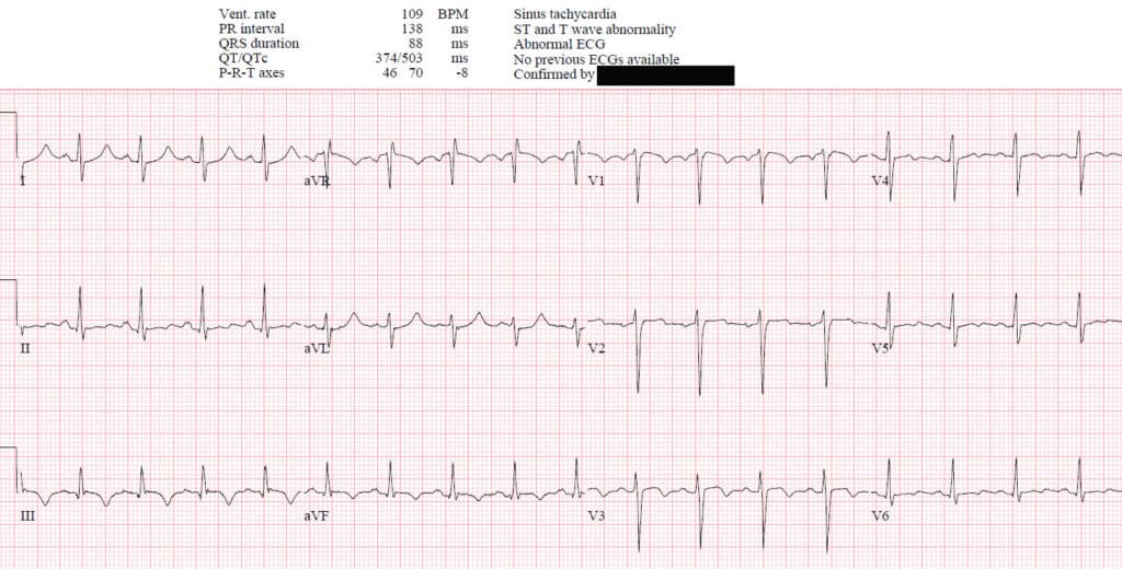 Beware Computer Interpretation Errors | ECG Cases | EM Cases