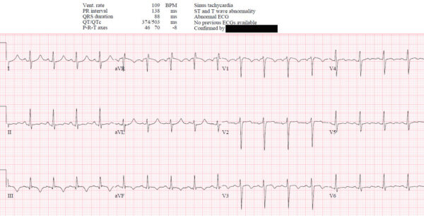 Beware Computer Interpretation Errors | ECG Cases | EM Cases