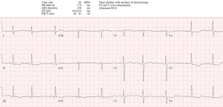 Beware Computer Interpretation Errors | ECG Cases | EM Cases