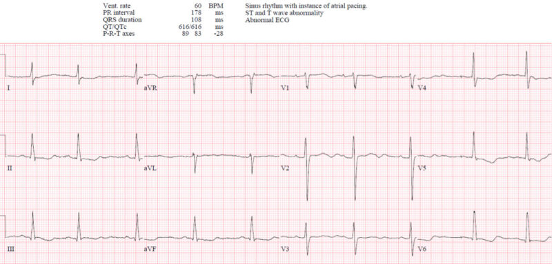 Beware Computer Interpretation Errors | ECG Cases | EM Cases