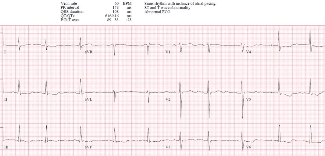 Beware Computer Interpretation Errors | ECG Cases | EM Cases