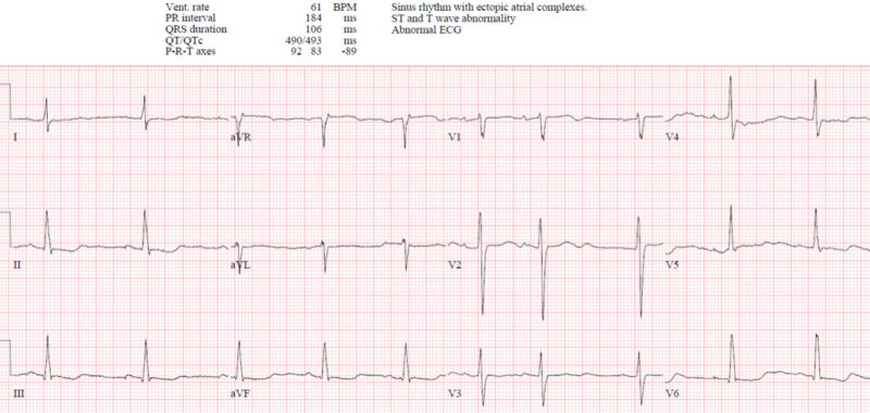 Beware Computer Interpretation Errors | ECG Cases | EM Cases