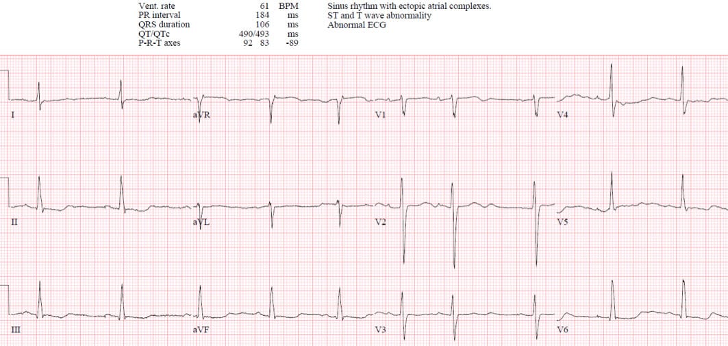 Beware Computer Interpretation Errors | ECG Cases | EM Cases