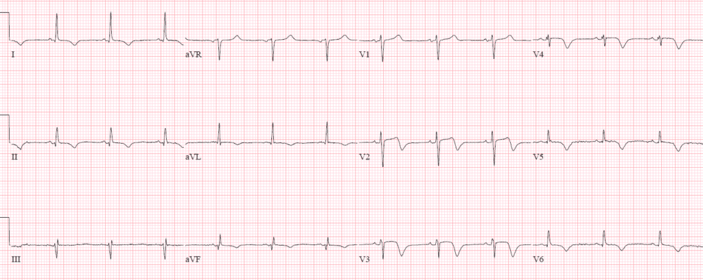 Beware Computer Interpretation Errors | ECG Cases | EM Cases