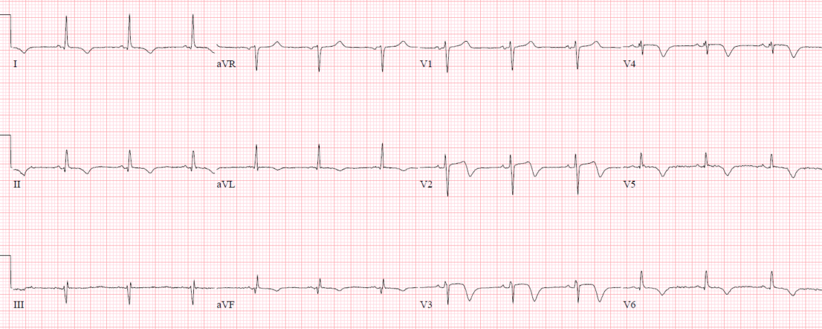 Beware Computer Interpretation Errors | ECG Cases | EM Cases