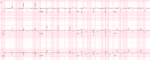 Beware Computer Interpretation Errors | ECG Cases | EM Cases