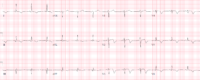 Beware Computer Interpretation Errors | ECG Cases | EM Cases