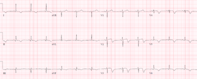 Beware Computer Interpretation Errors | ECG Cases | EM Cases