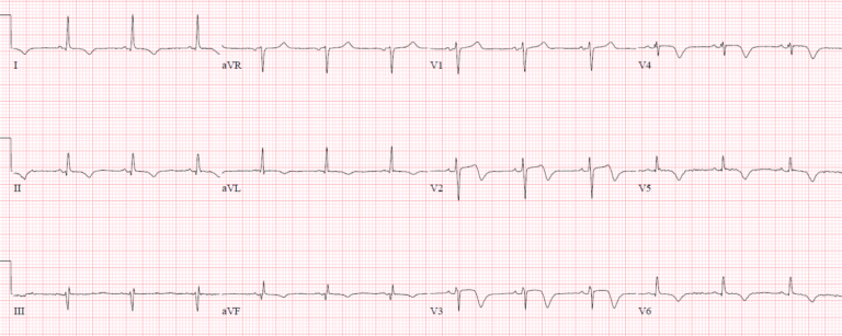 Beware Computer Interpretation Errors | ECG Cases | EM Cases