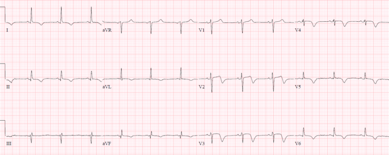 Beware Computer Interpretation Errors | ECG Cases | EM Cases