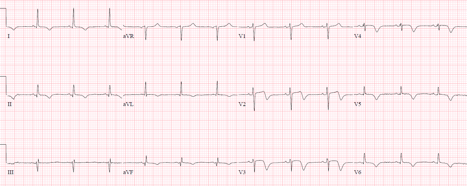Beware Computer Interpretation Errors | ECG Cases | EM Cases