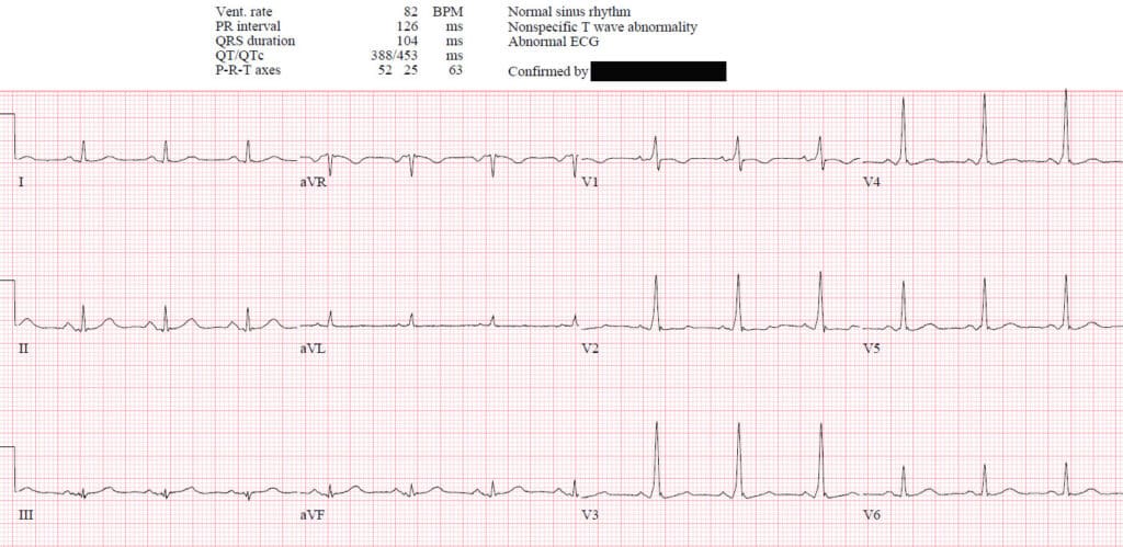 Beware Computer Interpretation Errors | ECG Cases | EM Cases