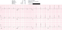 Beware Computer Interpretation Errors | ECG Cases | EM Cases