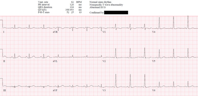Beware Computer Interpretation Errors | ECG Cases | EM Cases