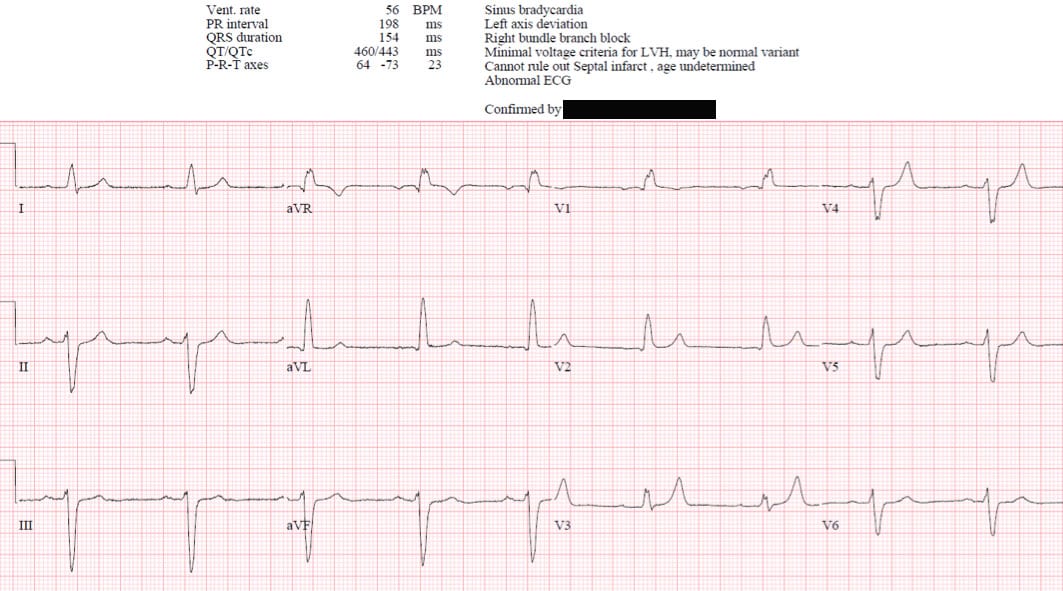 Beware Computer Interpretation Errors | ECG Cases | EM Cases