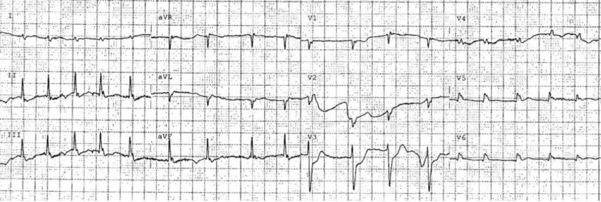 Is 15 lead ECG better than 12? Diagnosing Posterior MI and RVMI | ECG ...