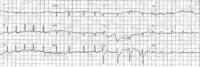 Is 15 lead ECG better than 12? Diagnosing Posterior MI and RVMI | ECG ...