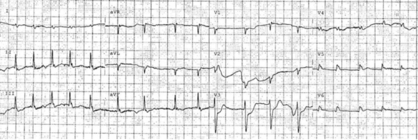 Is 15 lead ECG better than 12? Diagnosing Posterior MI and RVMI | ECG ...