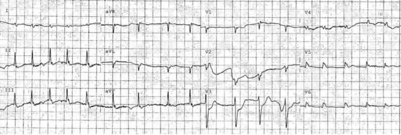 Is 15 lead ECG better than 12? Diagnosing Posterior MI and RVMI | ECG ...