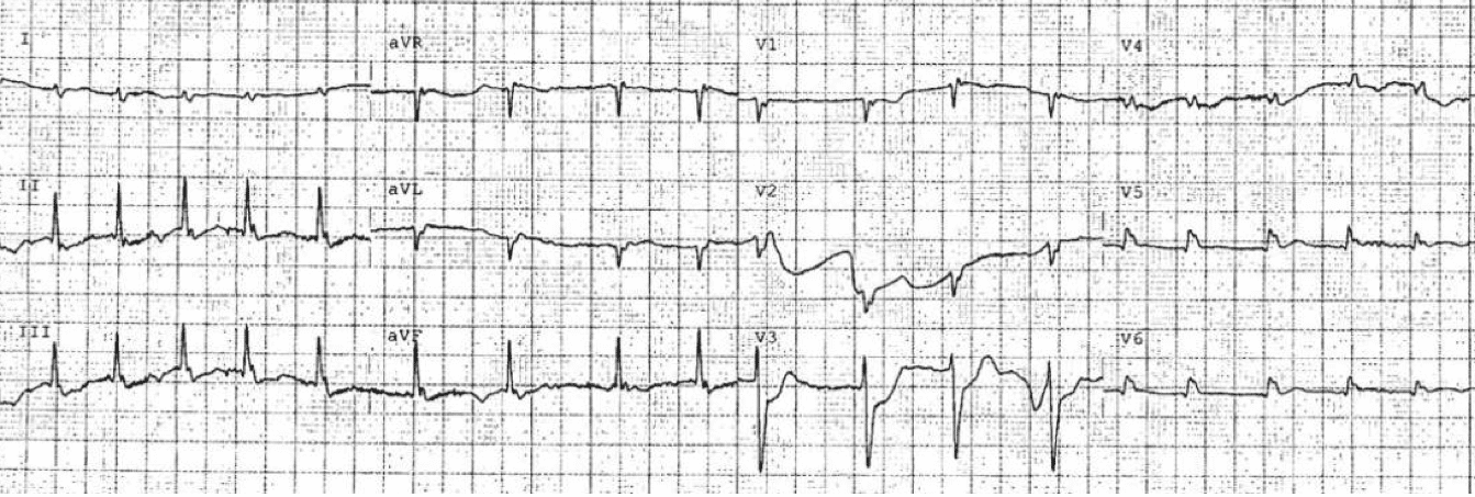 Is 15 lead ECG better than 12? Diagnosing Posterior MI and RVMI | ECG ...