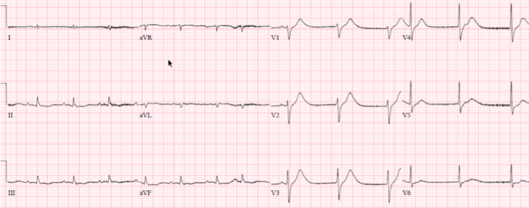 Is 15 lead ECG better than 12? Diagnosing Posterior MI and RVMI | ECG ...
